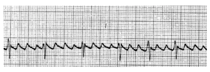 L'électrocardiogramme - ENTRAIDE ESI IDE