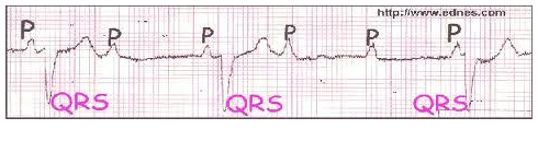 L'électrocardiogramme - ENTRAIDE ESI IDE