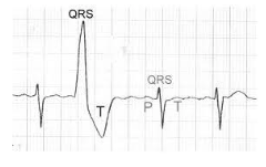 L'électrocardiogramme - ENTRAIDE ESI IDE