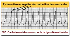 L'électrocardiogramme - ENTRAIDE ESI IDE