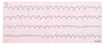 L'électrocardiogramme - ENTRAIDE ESI IDE