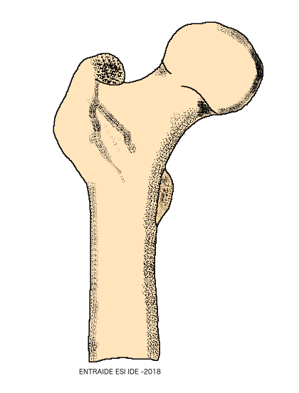 La fracture du col fémoral - ENTRAIDE ESI IDE